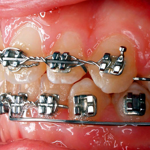 Functions of Different Parts of Your Braces – Markham ON | Markham ...